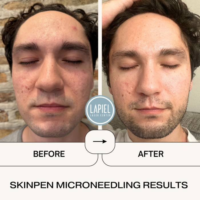 SkinPen Microneedling @ Lapiel - Lapiel Laser Center